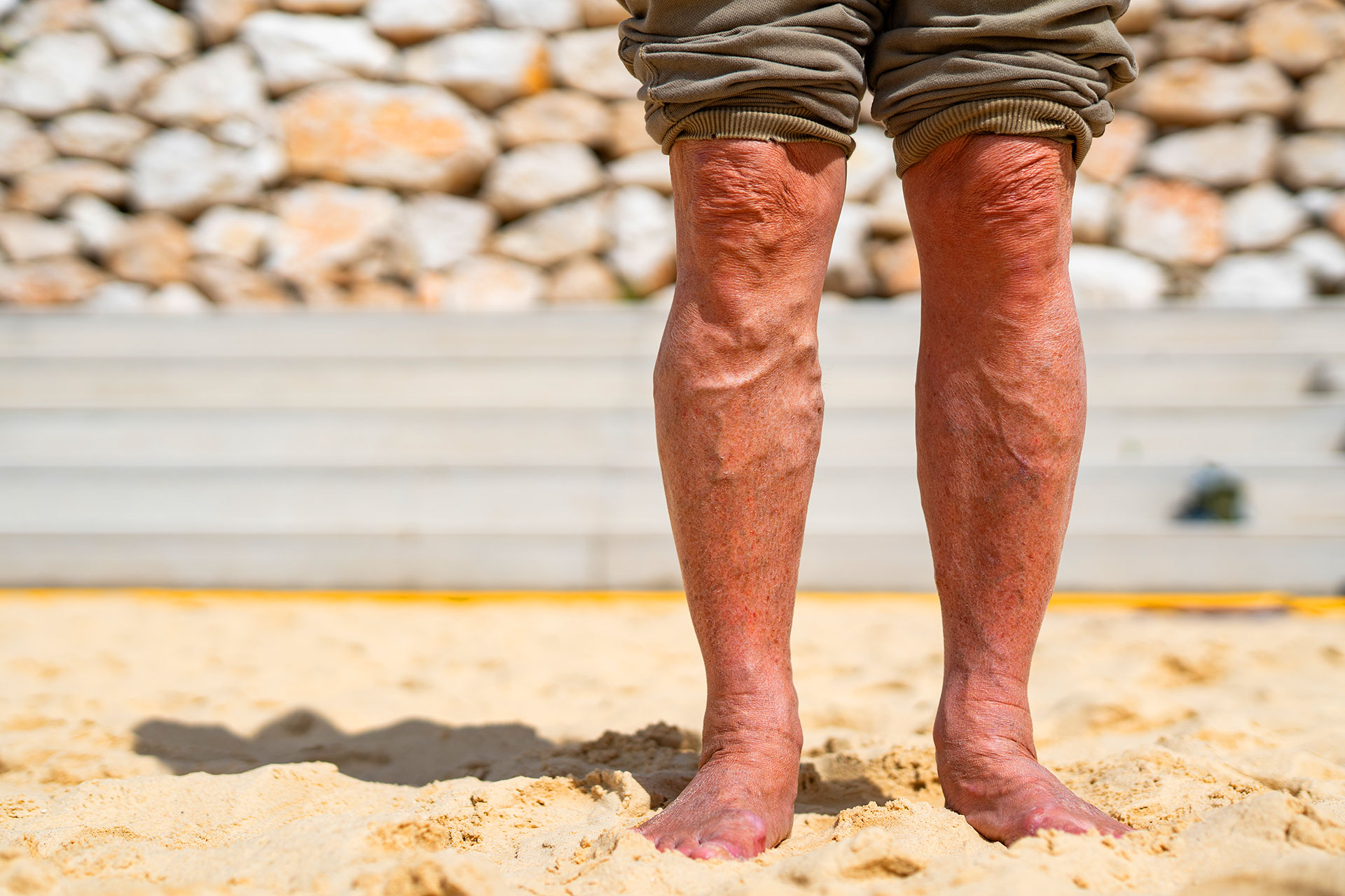 Bulging Veins in the Legs That Are Not Varicose Veins - Cura Vein Doctors