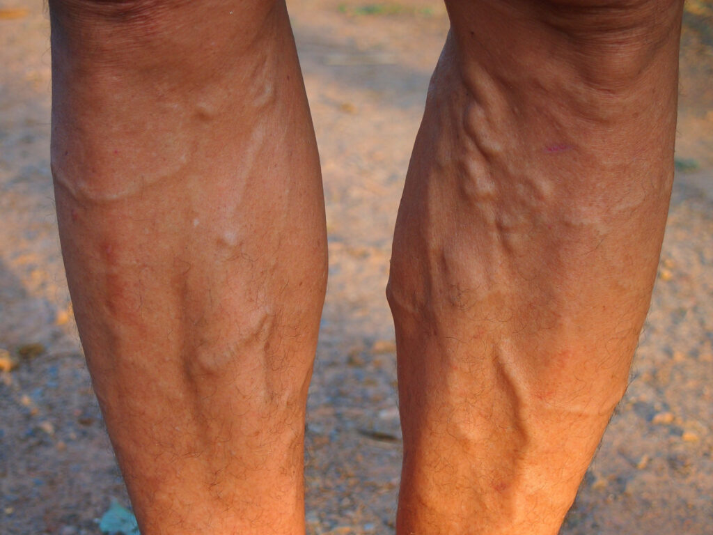 Bulging Veins in the Legs That Are Not Varicose Veins - Cura Vein Doctors