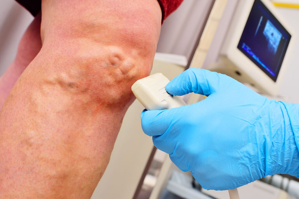 Bulging Veins in the Legs That Are Not Varicose Veins - Cura Vein Doctors
